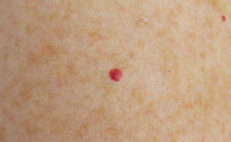 Cherry Angioma: Gejala, Penyebab, Diagnosis, dan Perawatan | IDN Times